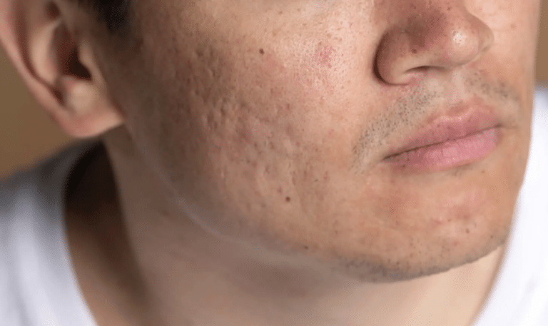 Reclaim Smooth Skin: A Complete Guide to Scar Reduction Treatment