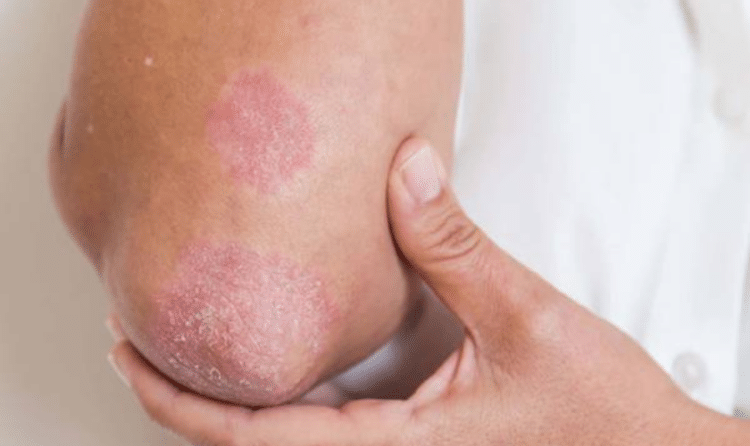 Understanding Fungal Infections: Causes, Prevention, and Treatment